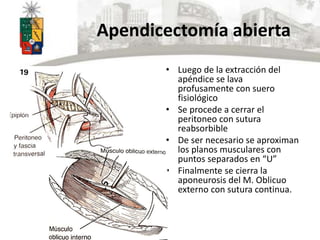 Apendicectomía abierta y vlp | PPTX