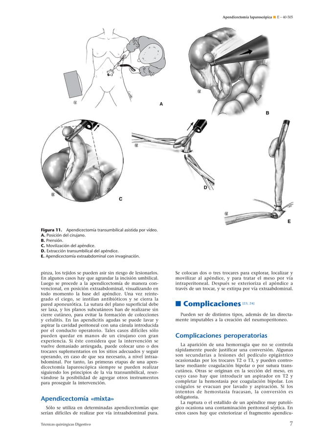 EMC. Apendicectomía laparoscópica