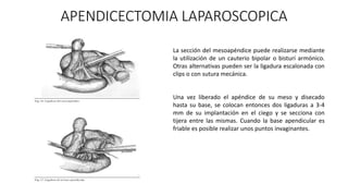 TRATAMIENTO QUIRURGICO DE LA APENDICITIS AGUDA | PPTX