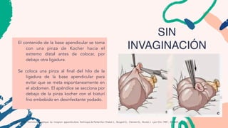 Apendicectomia tecnica quirurgica y manejo de muñon | PDF