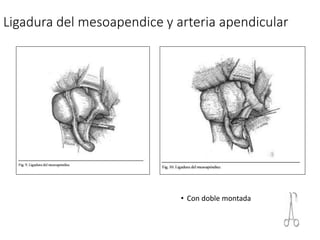 Apendicectomia 2015 | PPTX