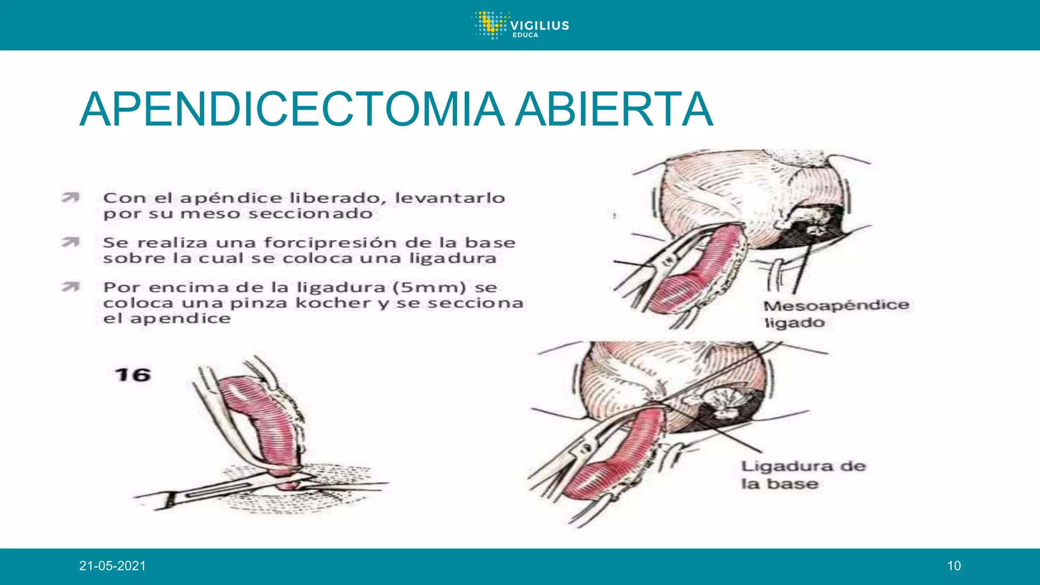 Apendicectomia abierta.pdf