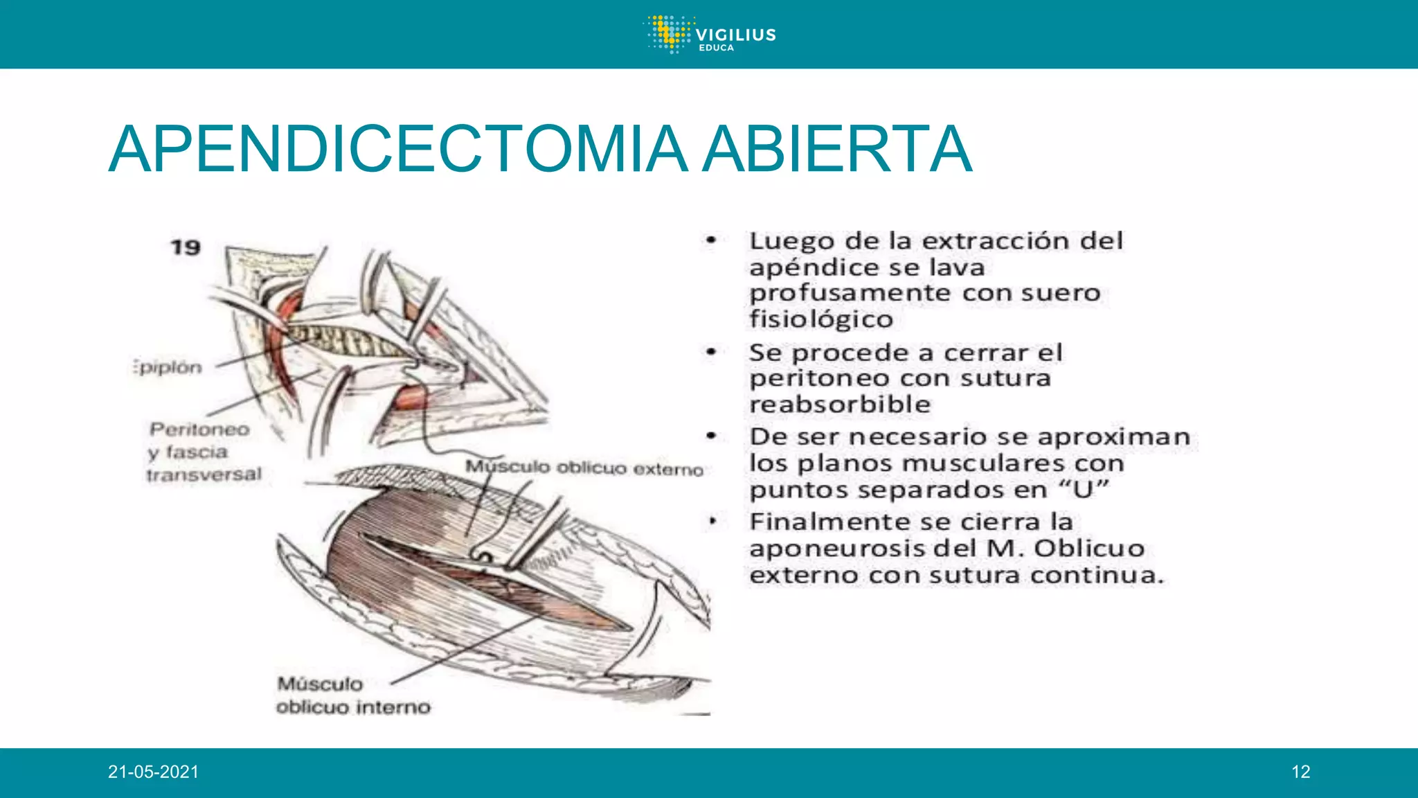 Apendicectomia abierta.pdf