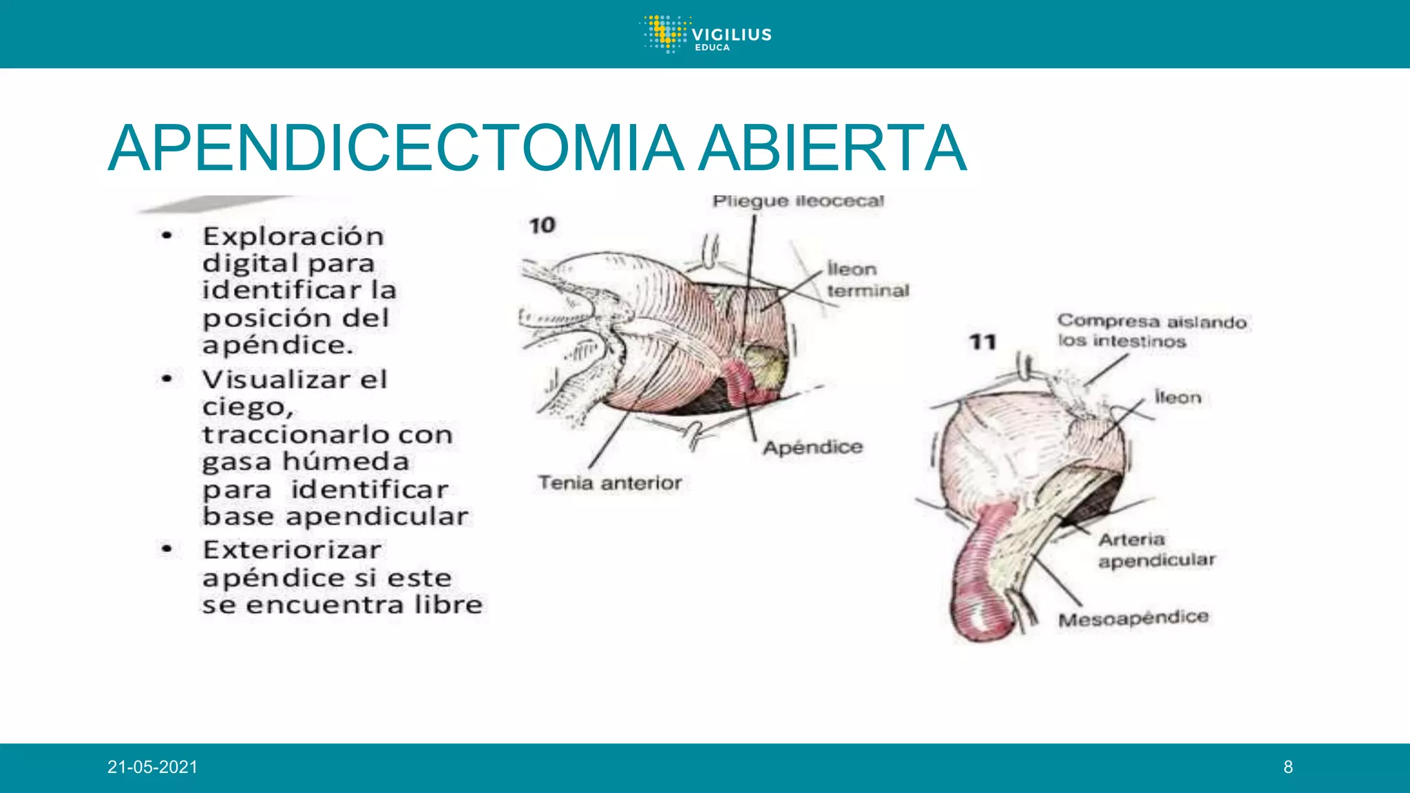 Apendicectomia abierta.pdf