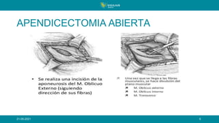 Apendicectomia abierta.pdf