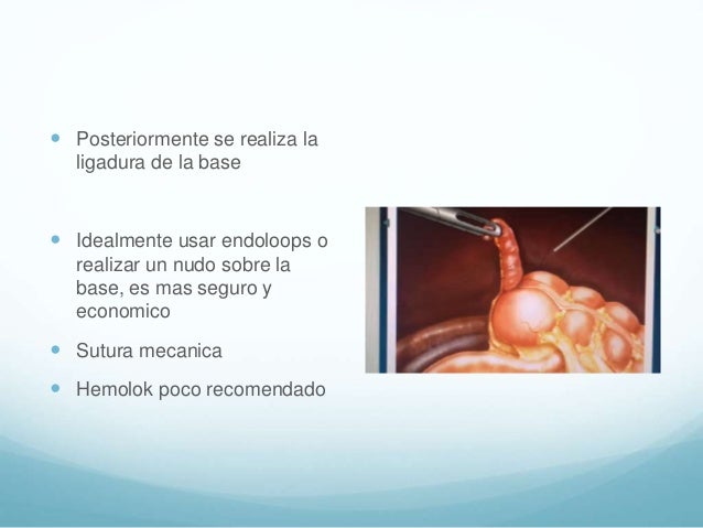 Apendicectomia laparoscopia