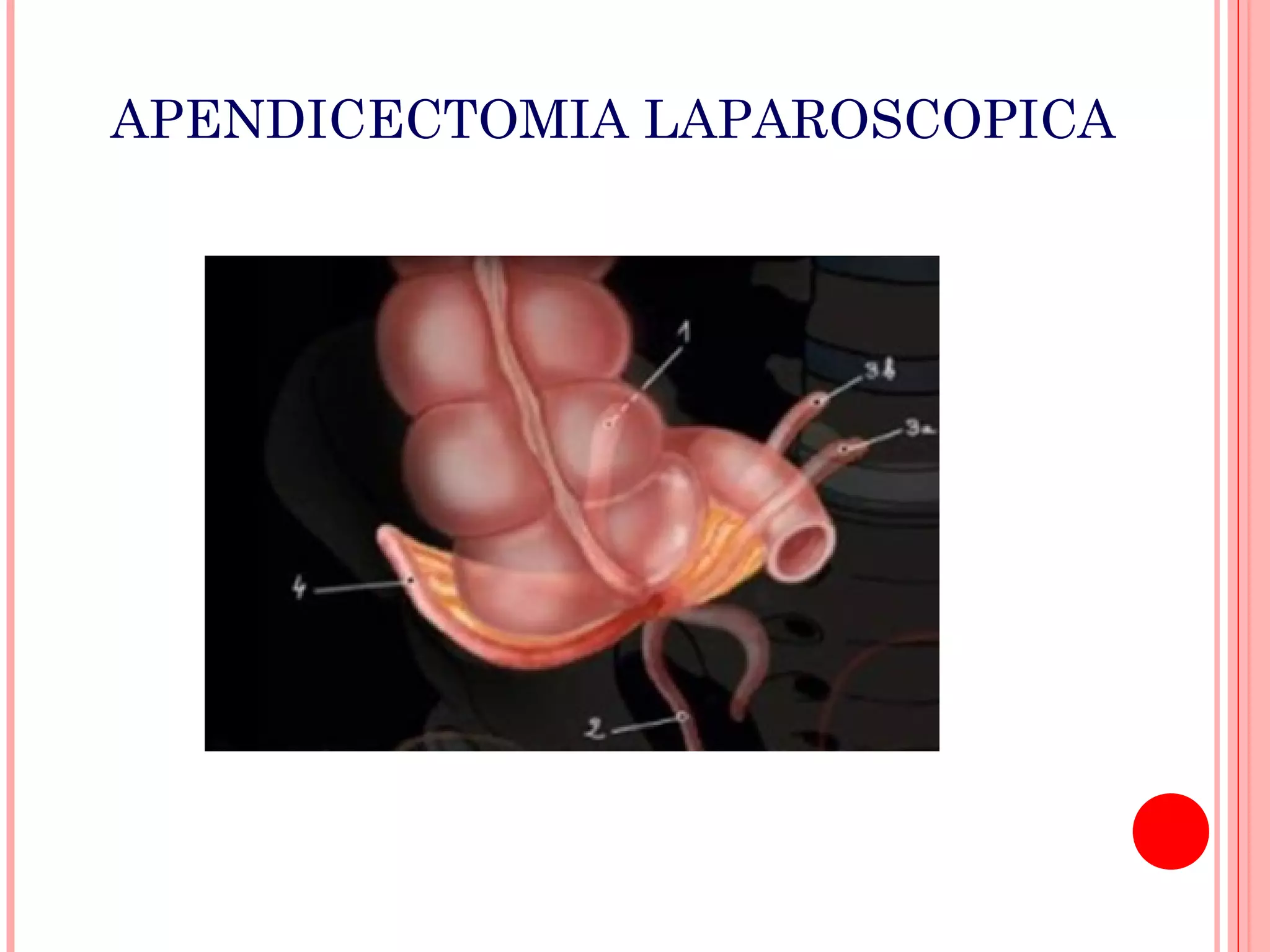 Apendicectomia laparoscopica | PPT | Surgery | Medical Health