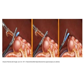 TECNICA DE APENDICECTOMIA LAPAROSCOPICA.pptx