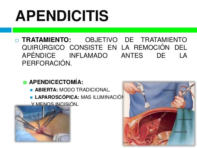 Apendicistis láminas romner rodriguez (2)
