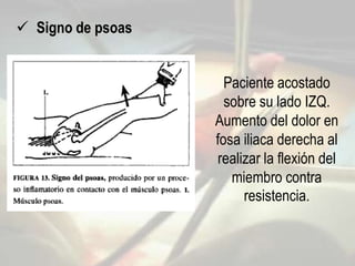 Apendicitis | PPTX