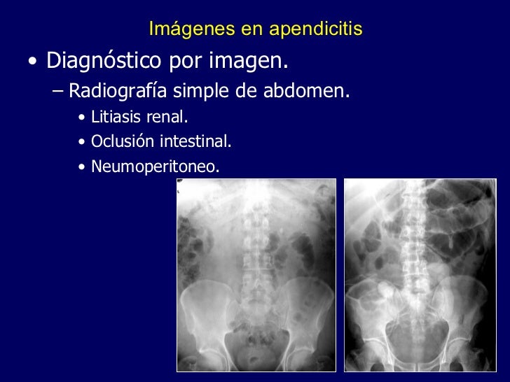 Apendicitis