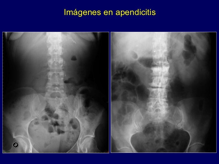 Apendicitis