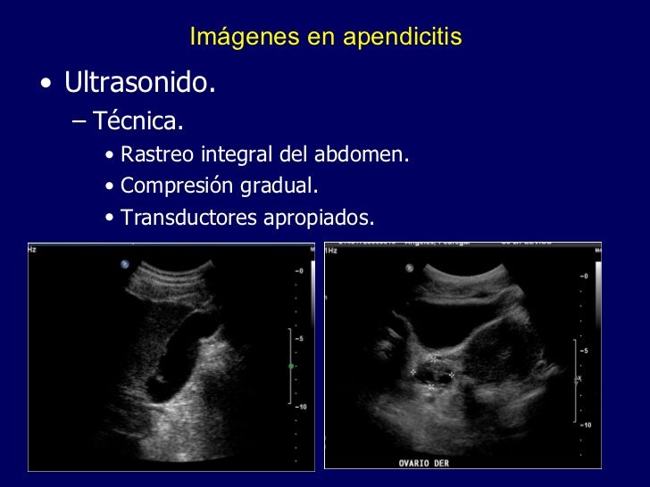 Apendicitis