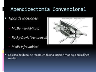 Apendicitis | PPTX