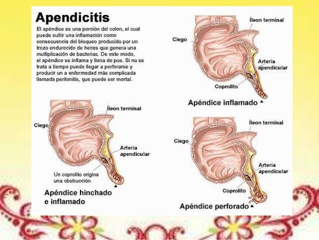 Apendicitis