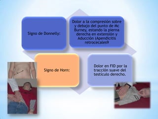 Apendicitis | PPTX