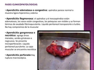 Apendicitis | PPTX