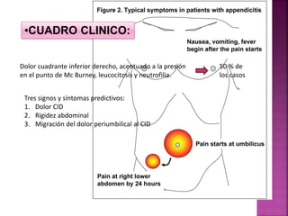 Apendicitis | PPTX