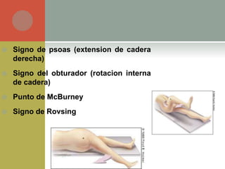 Apendicitis Aguda | PPTX