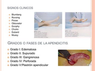 Apendicitis Aguda | PPTX