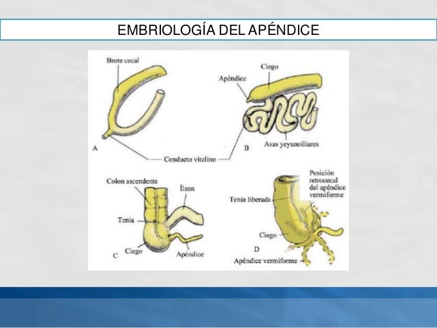 Apendicitis Aguda