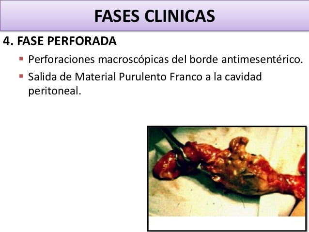Apendicitis - cirugía
