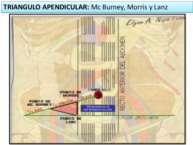 Apendicitis - cirugía