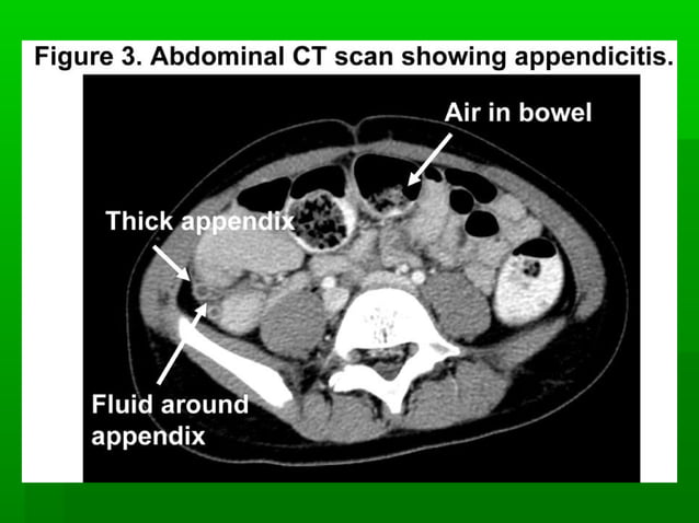 Apendicitis | PPT