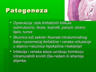 Apendicitis | PPT