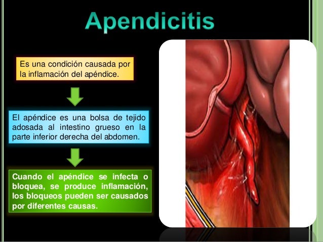 Apendicitis