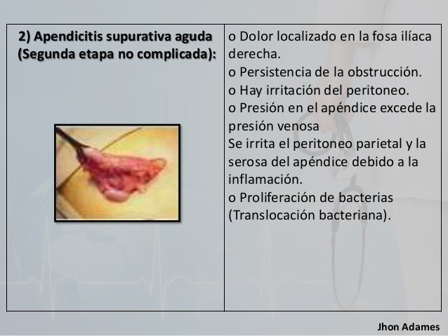 Apendicitis Aguda