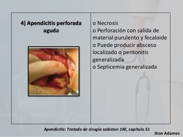 Apendicitis Aguda