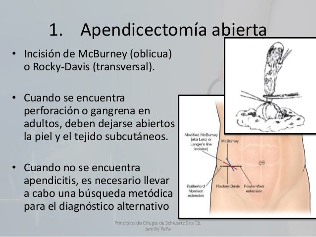 Apendicitis Aguda