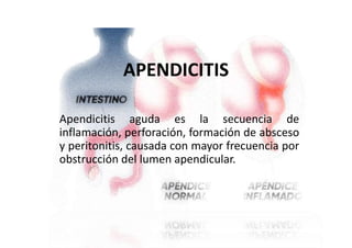 Apendicitis en el embarazo | PPTX