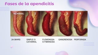 APENDICITIS.pptx