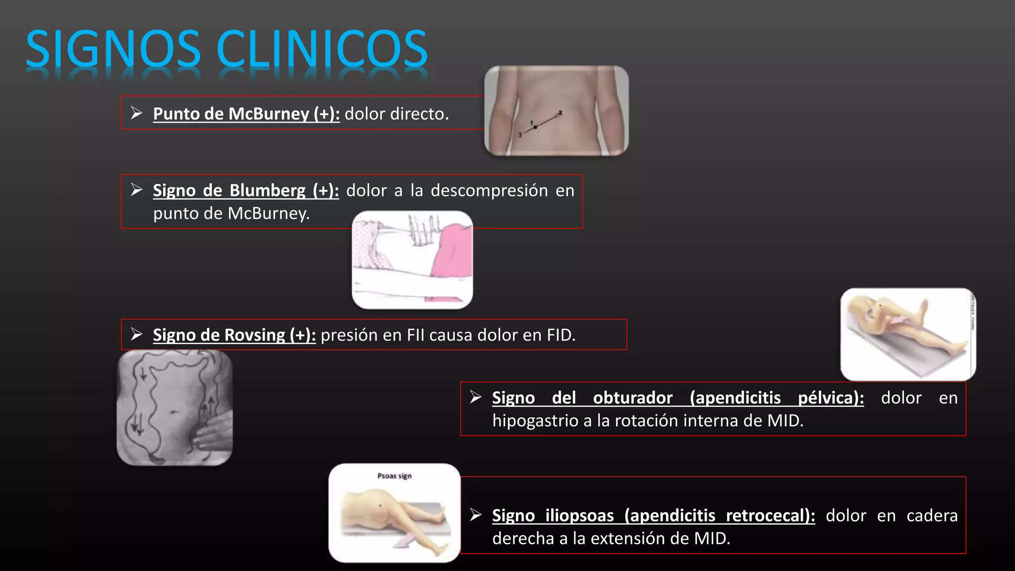 APENDICITIS | PPT