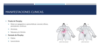 apendicitis.pptx
