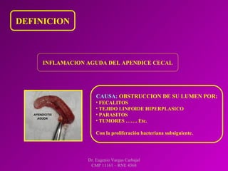 APENDICITIS AGUDA | PPT