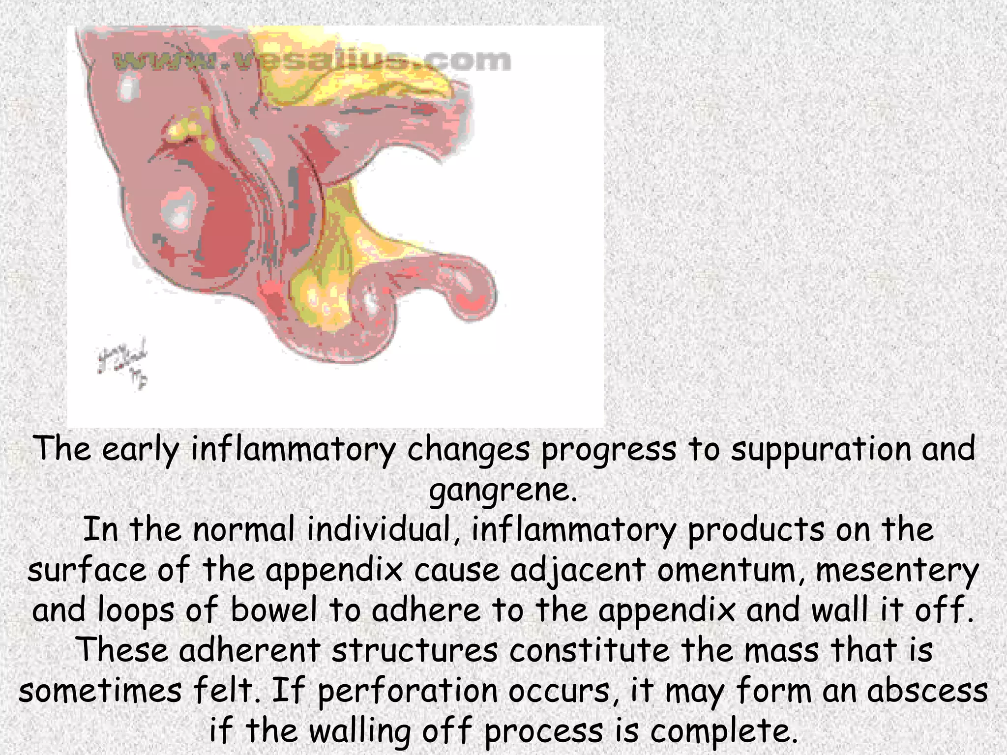 Apendicitis Aguda | PPT | Death, Injury, or Military Conflict ...