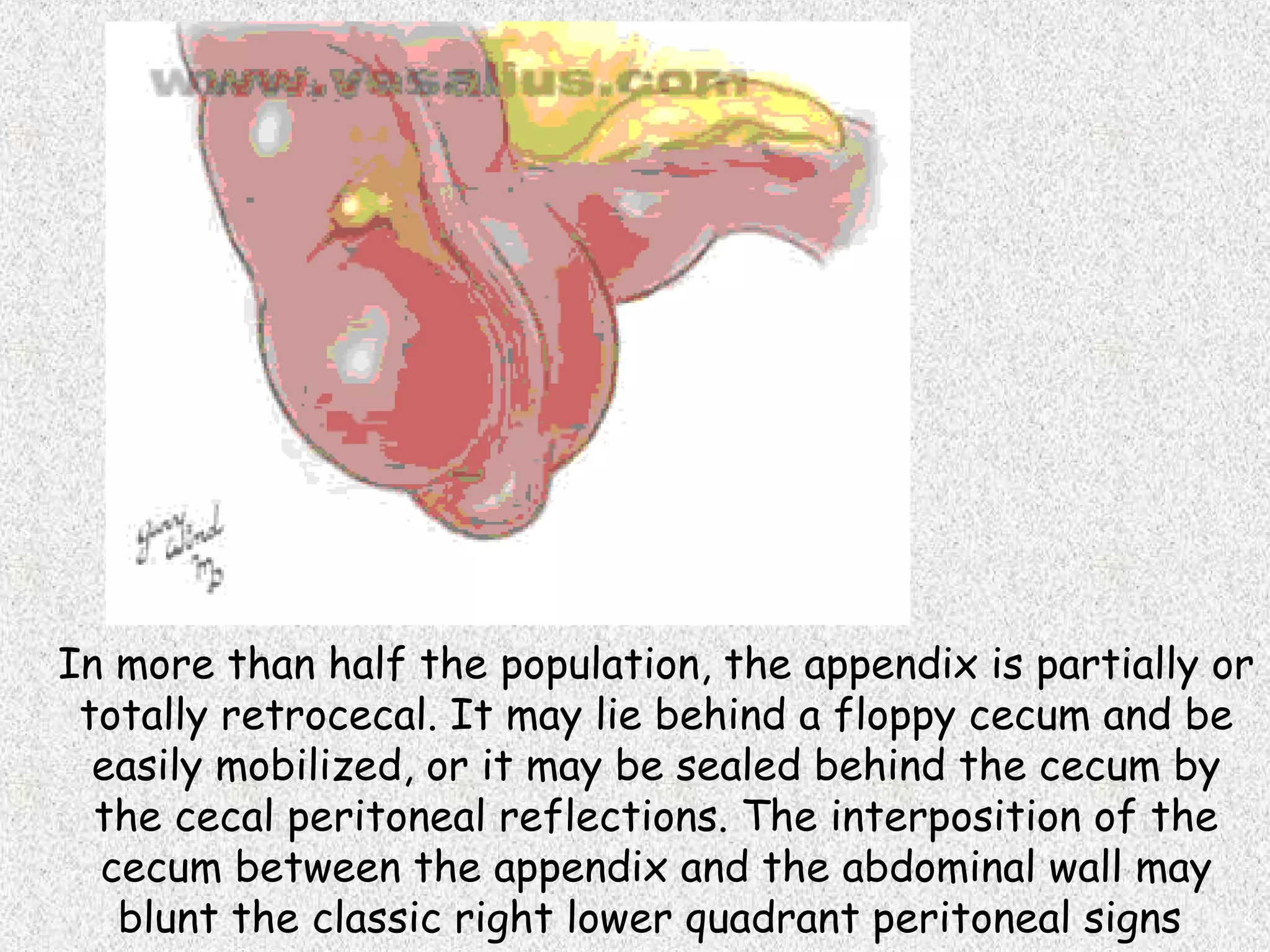 Apendicitis Aguda | PPT | Death, Injury, or Military Conflict ...