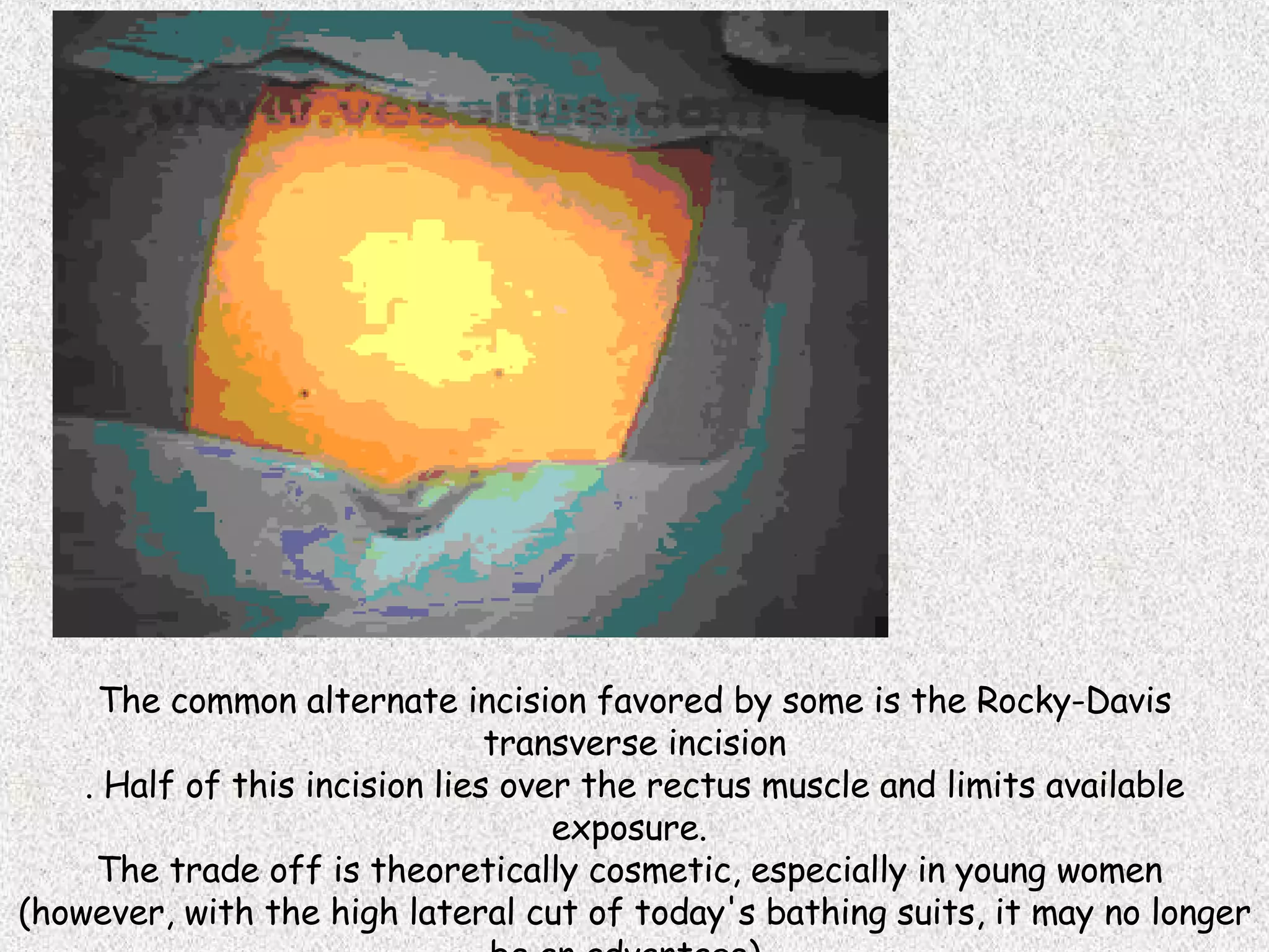 Apendicitis Aguda | PPT | Death, Injury, or Military Conflict ...