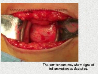 Apendicitis Aguda | PPT