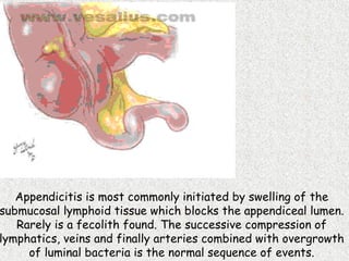 Apendicitis Aguda | PPT | Death, Injury, or Military Conflict ...