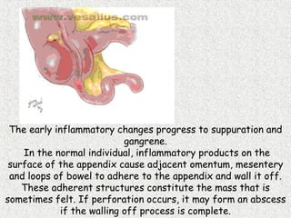 Apendicitis Aguda | PPT