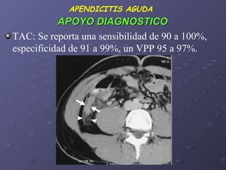 APENDICITIS AGUDA | PPT
