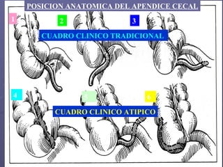 APENDICITIS AGUDA | PPT