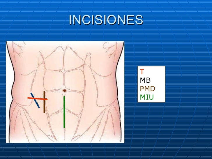 Apendicitis Aguda y Apendicectomia