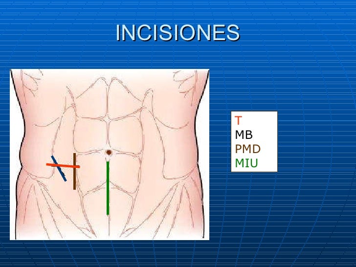 Apendicitis Aguda Para Apresentar
