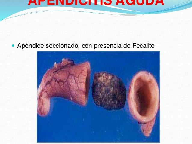 Apendicitis Cirugía Abdomen