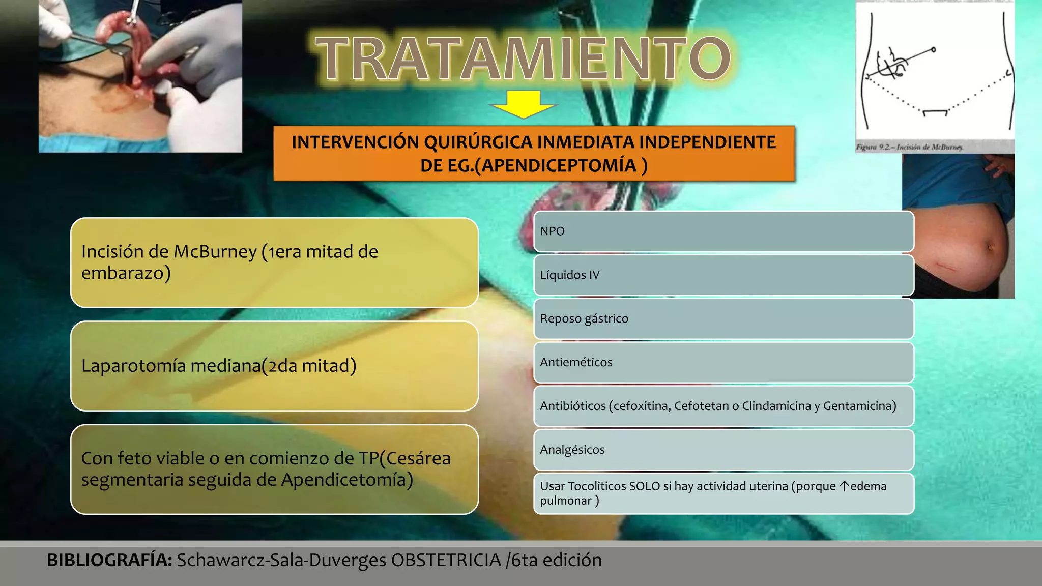 APENDICITIS EN EL EMBARAZO OBSTETRICIA | PPT